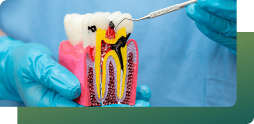 Root Canal Treatment Stages: What To Expect At Each Step